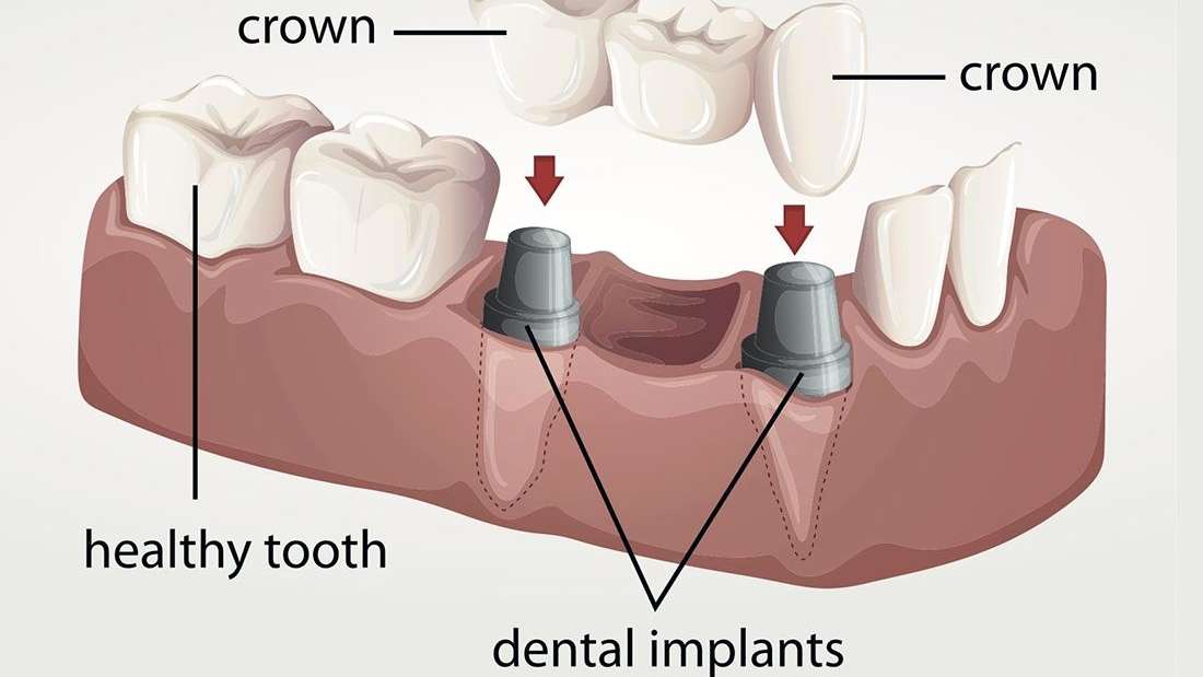 Dentures 101 – Everything You Need to Know | Dentures Aurora Colorado